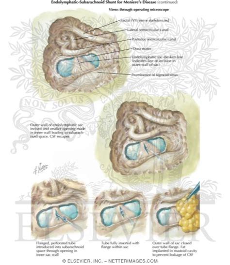 Decompression Endolymphatic Sac Decompression