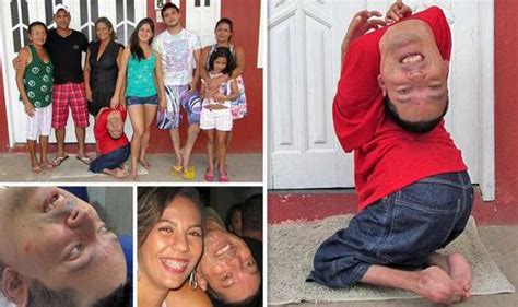 Brazilian Man Born With Upside Down Head Defies All Odds Pics And Video Health Nigeria