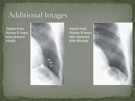 Chf Exacerbation