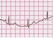 Cardiology Flashcards Quizlet