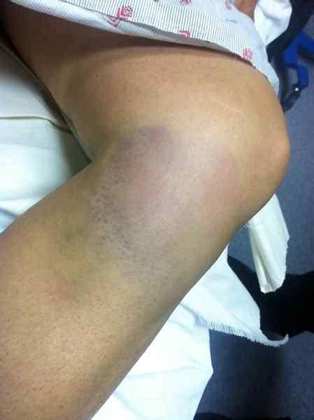 Apa Perbedaan Antara Memar Dan Hematoma Prodiffs