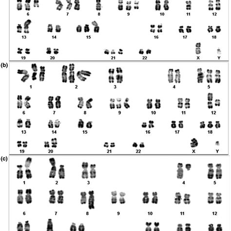 Gender Distribution In The Multiple Myeloma Cases Download Scientific