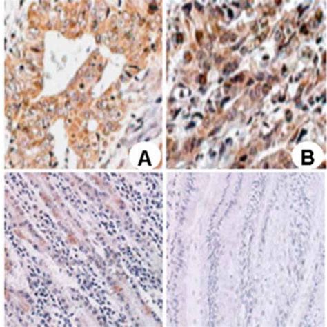 Expression Of Rpl15 In Normal Gastric Mucosa Gastric Cancer And