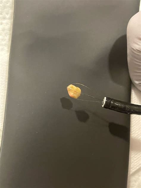 Michael Talalaev On Linkedin Bronchialforeignbody Fbremoval Interventionalpulmonology