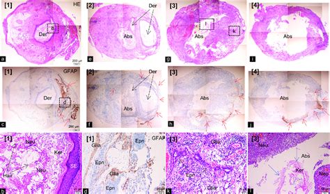 Histopathological Findings Of The Resected Cord Like Structure C Ls Download Scientific Histopathological Findings Of The Resected Cord Like Structure C Ls Download Scientific
