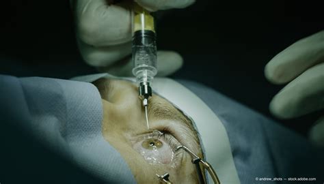 Intravitreal Injection Therapy Icare Surgical Centre