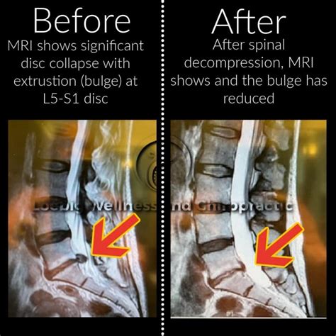 The Power Of Non Surgical Decompression Pittsburgh East Health Center