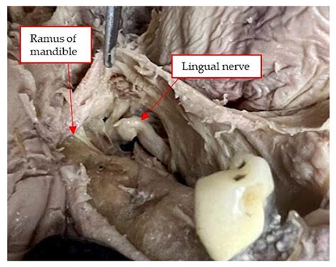 Mandibular Nerve Cadaver