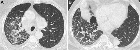 An Algorithmic Approach To The Interpretation Of Diffuse Lung Disease