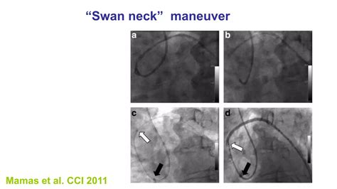 Cto In Post Cabg Patients Ppt