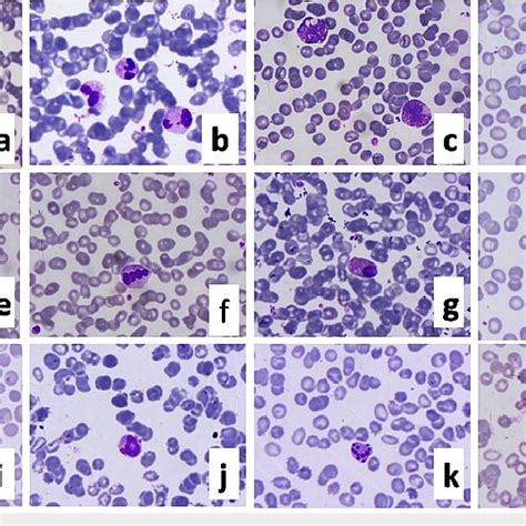 Peripheral Blood Smear A Activated Monocyte With Multiple Cytoplasmic