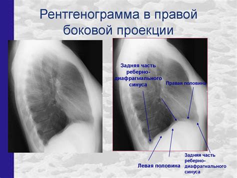Рентгенанатомия грудной клетки презентация онлайн