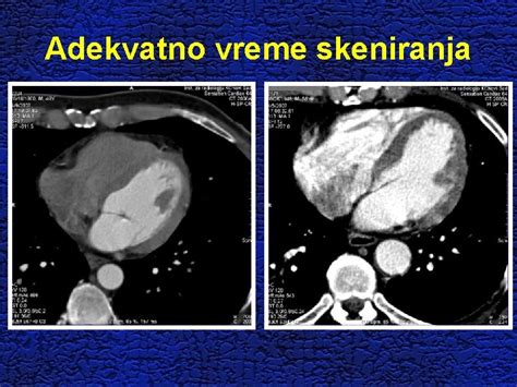 MSCT Koronarografija Duanka Vojnovi Sanja Stojanovi Stevan Iuki
