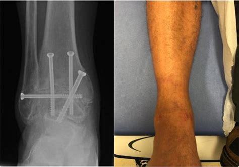 Ankle Fusion Arthroscopic Approach — Dr Sagar Desai