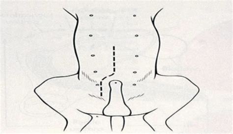 Lecture 23 Exploratory Celiotomy Flashcards Quizlet