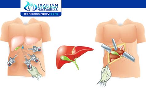 Laparotomy Vs Laparoscopy Laparoscopy Vs Laparotomy Iranian Surgery
