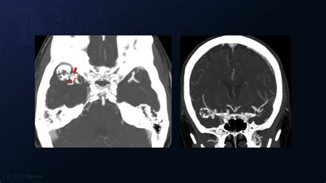 299 Trapping And Excision Of A Calcified Mca Aneurysm With An
