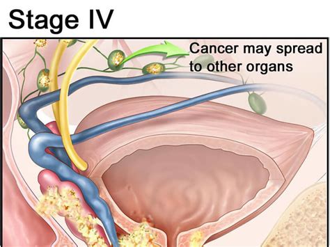 New Subtype Of Treatment Resistant Prostate Cancer Nci
