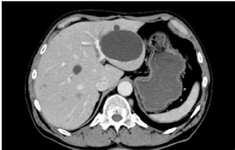 Abdominal Ct Findings At 3 Postoperative Months Reveal Multiple Liver