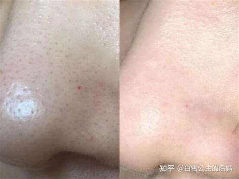 为什么医学生强烈建议你黑头爬满鼻子时候，直接用乳糖酸去除？！ 知乎