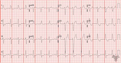 Left Bundle Branch Block ECG Stampede