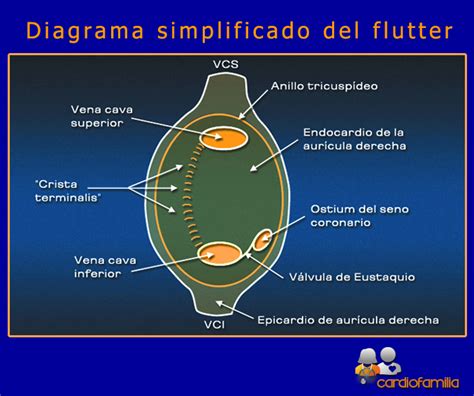 Etiología clínica y tratamiento del flutter auricular