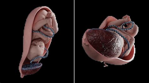 Placenta Praevia Klassifikation Ursachen Symptome Therapie