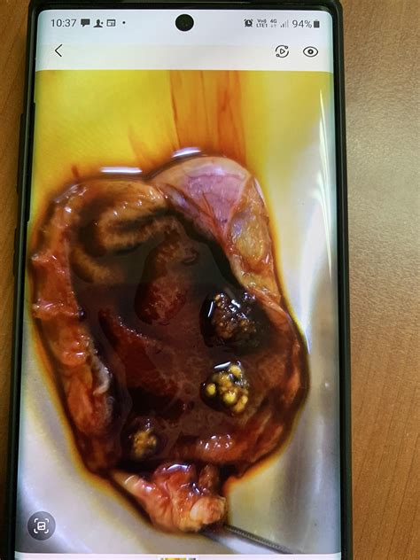 My Big Polyps Lol They Are Benign Thank God R Gallbladders