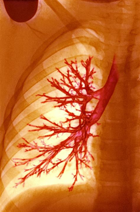 Lung Bronchioles X Ray Photograph By Cnri Fine Art America