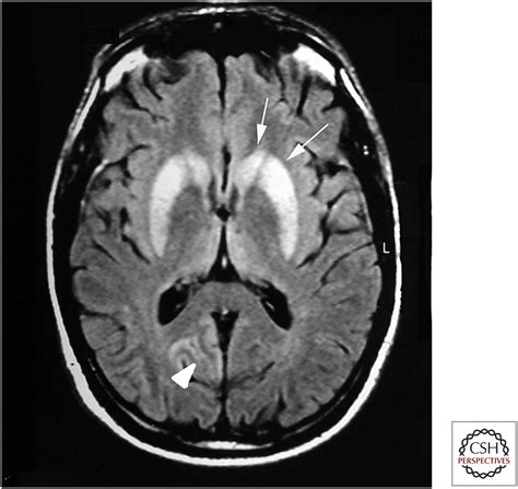 Sporadic And Infectious Human Prion Diseases