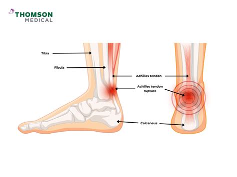 Achilles Tendon Rupture Causes Symptoms And Treatments Thomson Medical