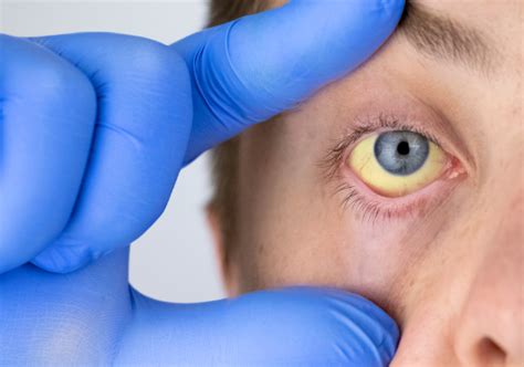 소아 급성 간염 원인 종류 증상 및 징후 진단 검사 방법 어린이 유아 간염 경우 치료는 자가면역 밖에 없으며 예방 만이