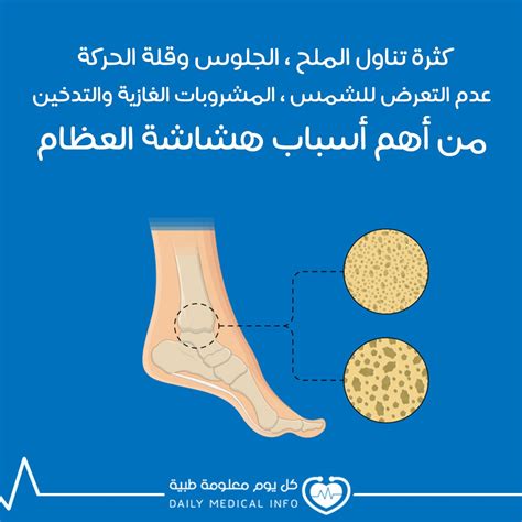 كل يوم معلومة طبية هذه هي أهم أسباب هشاشة العظام ، تعرف عليها من