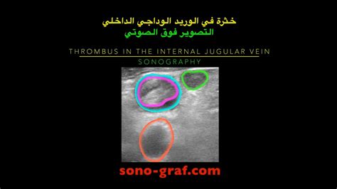 التصوير بالموجات فوق الصوتية خثرة في الوريد الوداجي الداخلي YouTube