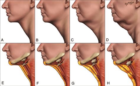 Illustrative Example Depicting Knizes Classification Of Cervicomenta