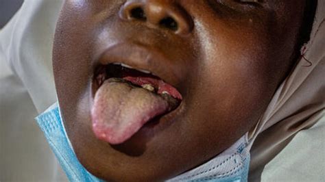 Nigeria Records 7202 Diphtheria Cases 453 Deaths Premium Times Nigeria