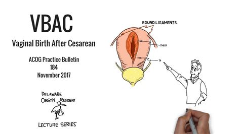 Vaginal Birth After Cesarean De Obgyn Resident Lecture Series With