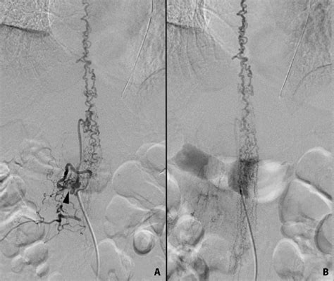 Selective Angiography Of The Right L1 Segmental Artery In The Early