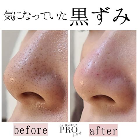 毛穴エクストラクションの変化 奈良大和高田 小顔矯正と美肌 で若々しく変化！まごころエステmatoria