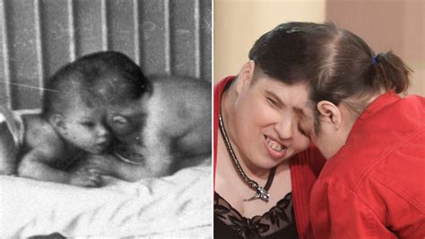 Conjoined Twins Separated A First Ever Separation Of Conjoined Twins
