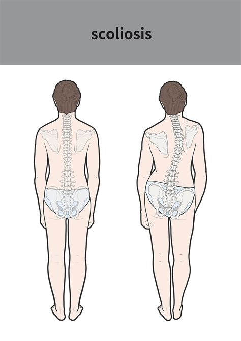 척추측만증 메디컬일러스트 On Behance