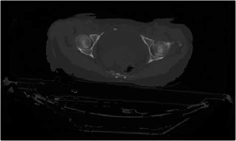 Example Of Error In Ct Deformable Registration Download Scientific Diagram