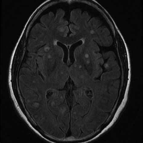 T2‐weighted Fluid Attenuated Inversion Recovery Flair Brain Magnetic