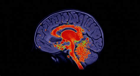 AI Powered Landmark Detection In Medical Imaging Achieving High Accuracy With NnLandmark