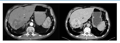 Pdf Right Hepatectomy For Giant Liver Hemangioma Guided With