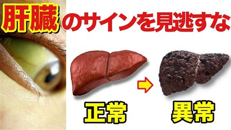 衝撃その症状あなたの肝臓の悲鳴かも助けを求めている肝臓のサイン9選 YouTube