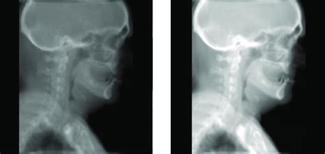 Reconstructions For A Medical Data Set From The Fourier Volume