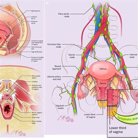 Zonal Vaginal Anatomy On Mri Sagittal A And Axial B T2 Weighted