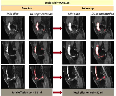 Validation Of Quantitative Effusion Synovitis Volume Measured By Deep