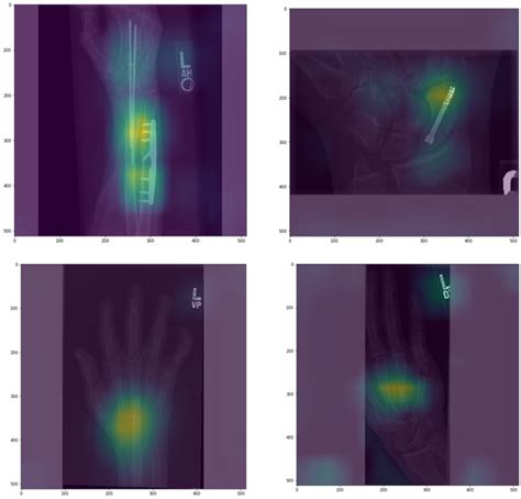 Github Htyangsbone Abnormality Classification Bone Abnormalities